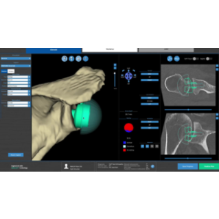 Shoulder iD™ | Stryker